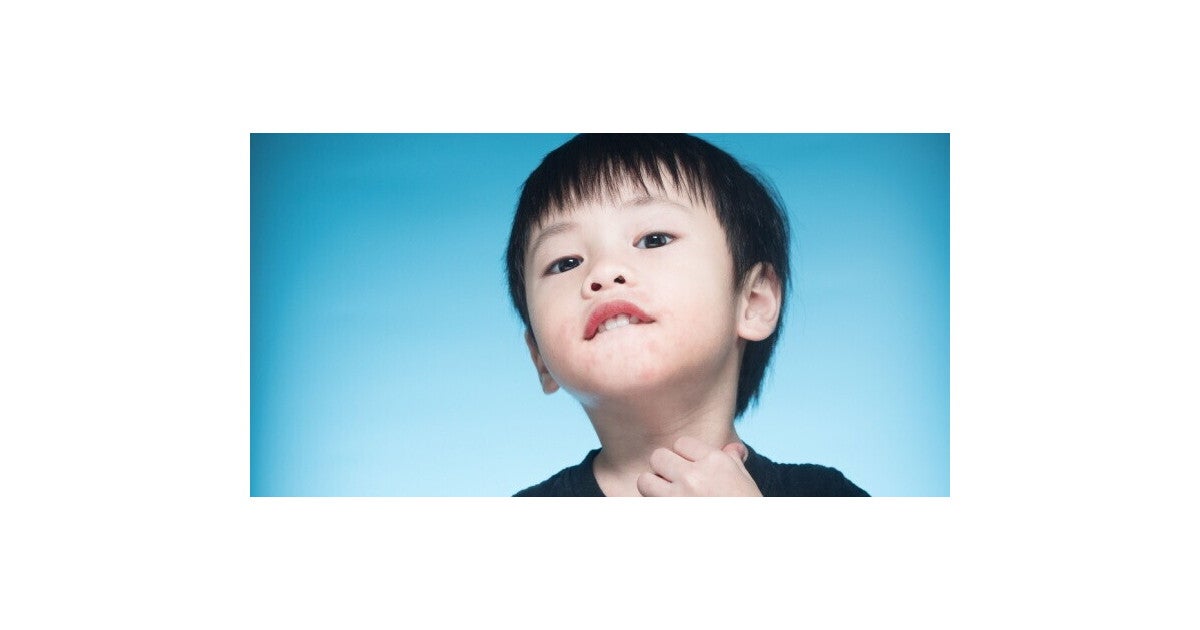 8 Gejala Alergi Susu Sapi pada Anak dan Cara Menanganiny