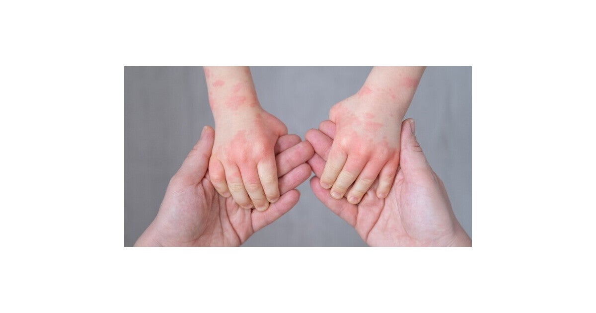 Ciri ciri Alergi susu sapi pada si Kecil dan Cara Pencegahannya